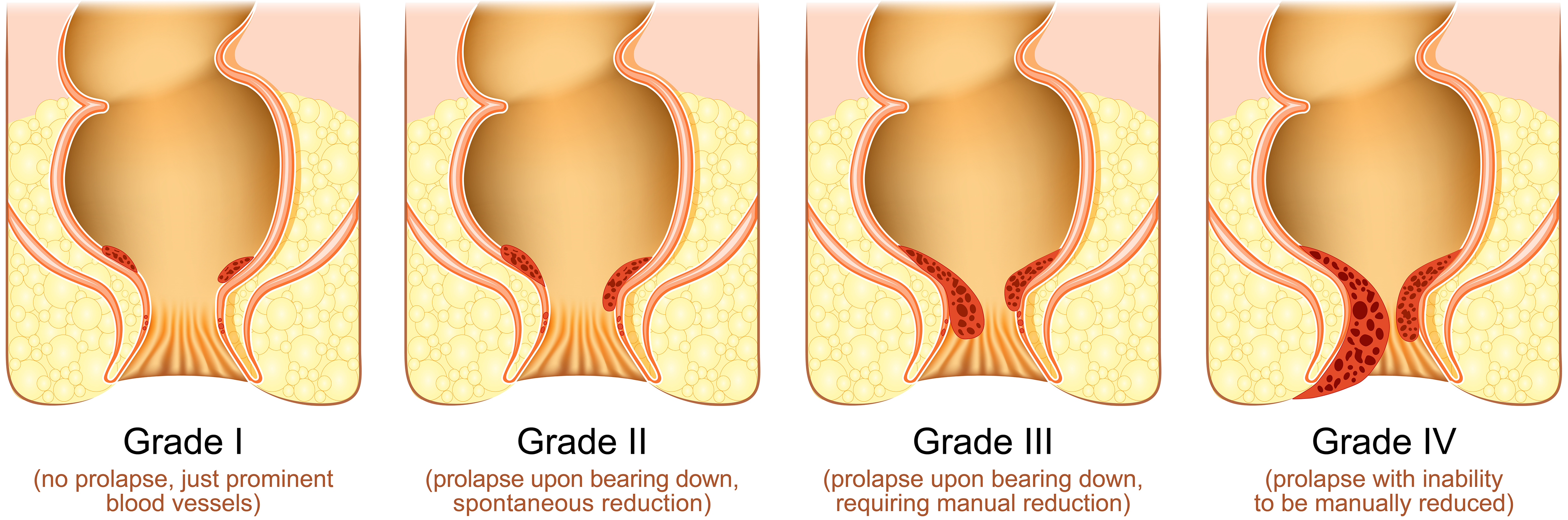 prolapse grading
